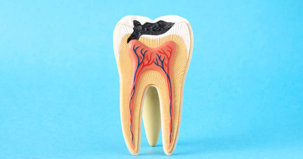 Vital Pulp Therapy: Saving Children's Teeth Effectively