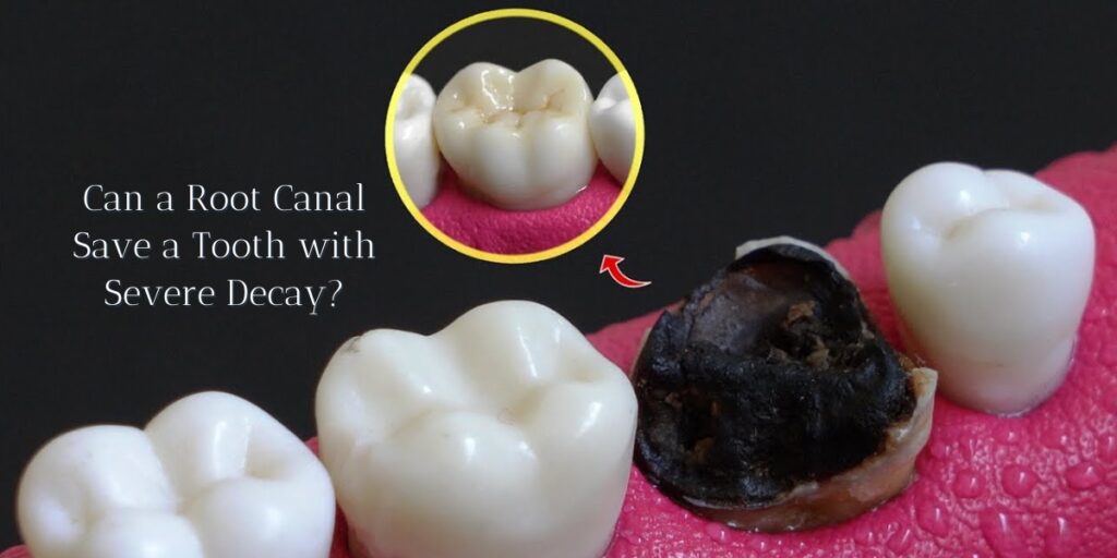 Understanding Pain After Root Canal: Key Insights