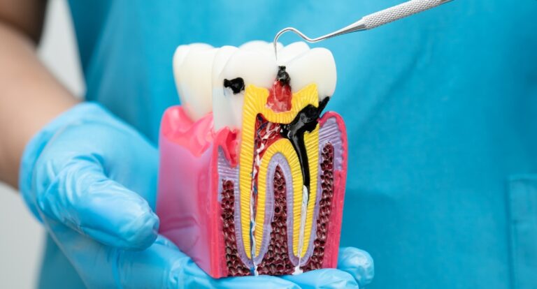 Understanding Pain After Root Canal: Key Insights